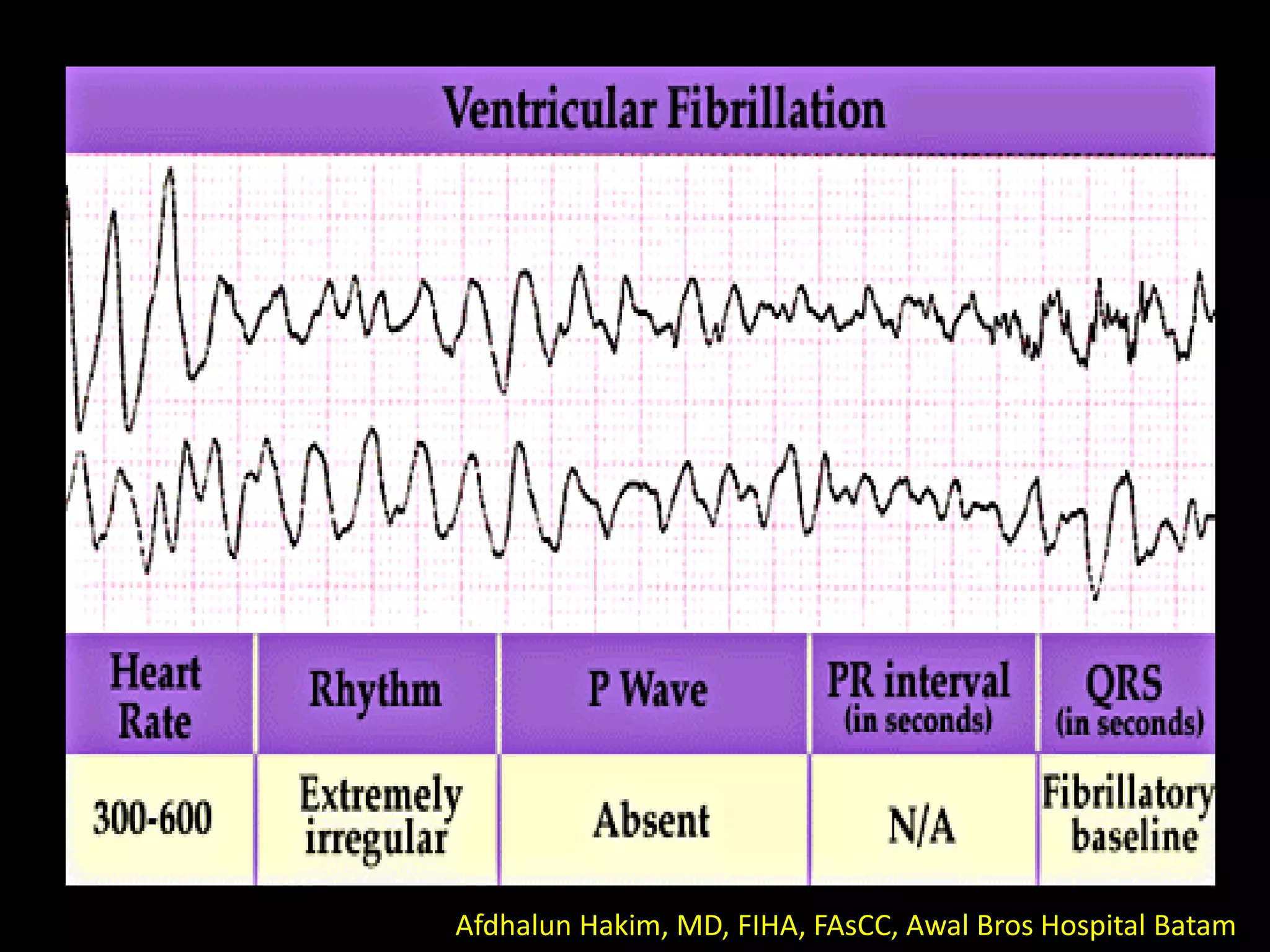 Ventricular aritmia (VT) Afdhalun Hakim, MD, FIHA, FAsCC | PDF