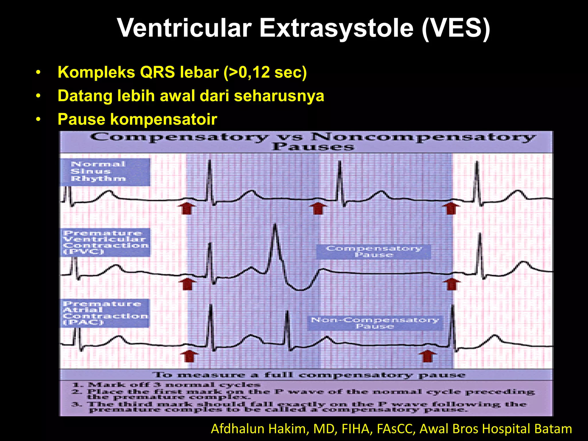 Ventricular aritmia (VT) Afdhalun Hakim, MD, FIHA, FAsCC | PDF