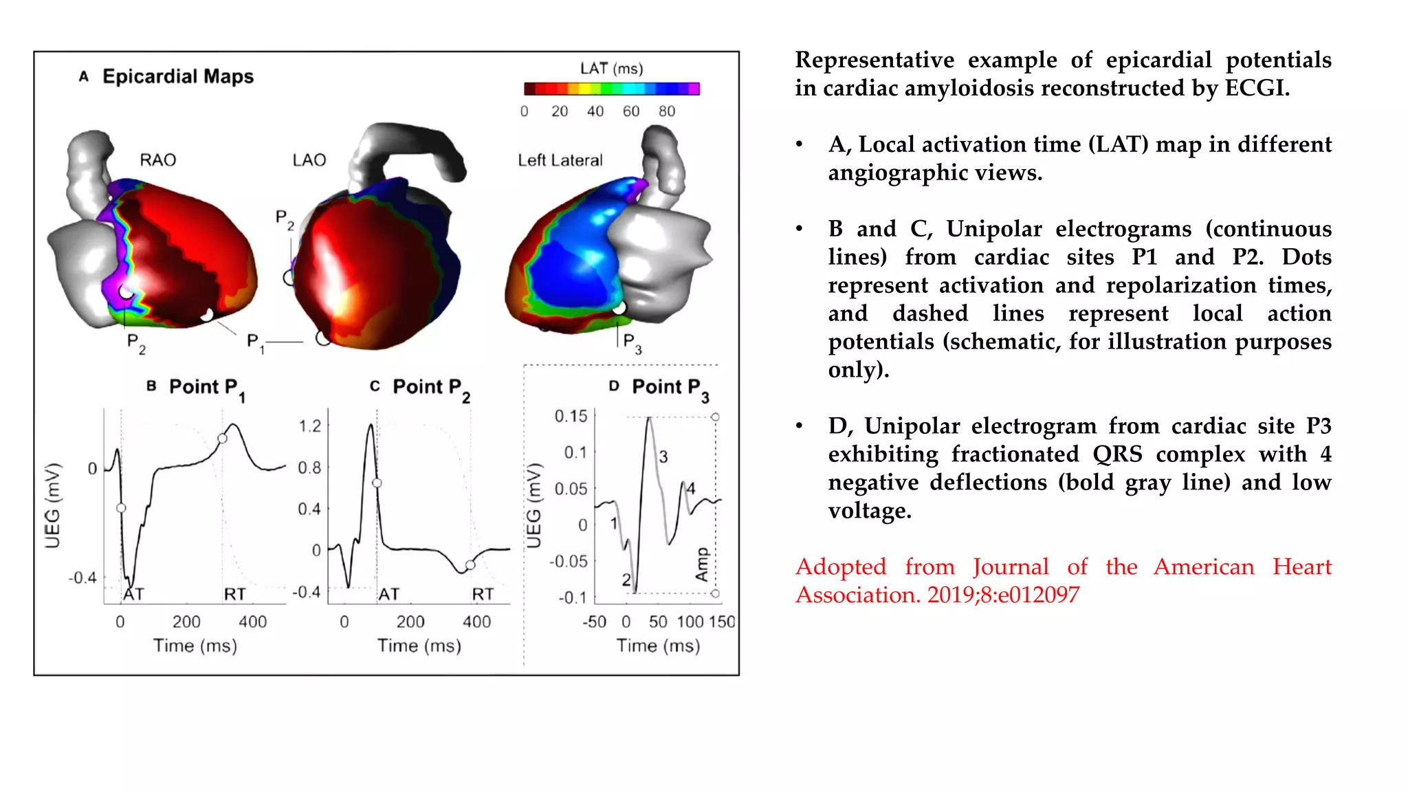 Ventricular Arrhythmias in Cardiac Amyloidosis.pdf | Heart and ...