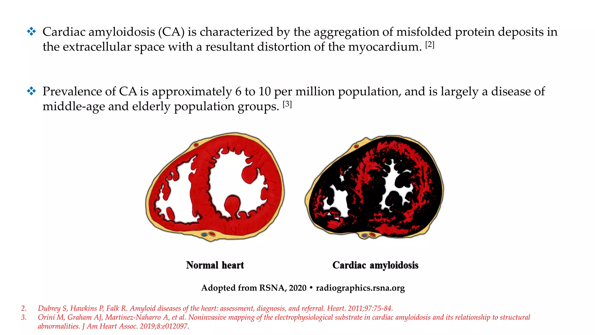 Ventricular Arrhythmias in Cardiac Amyloidosis.pdf | Heart and ...