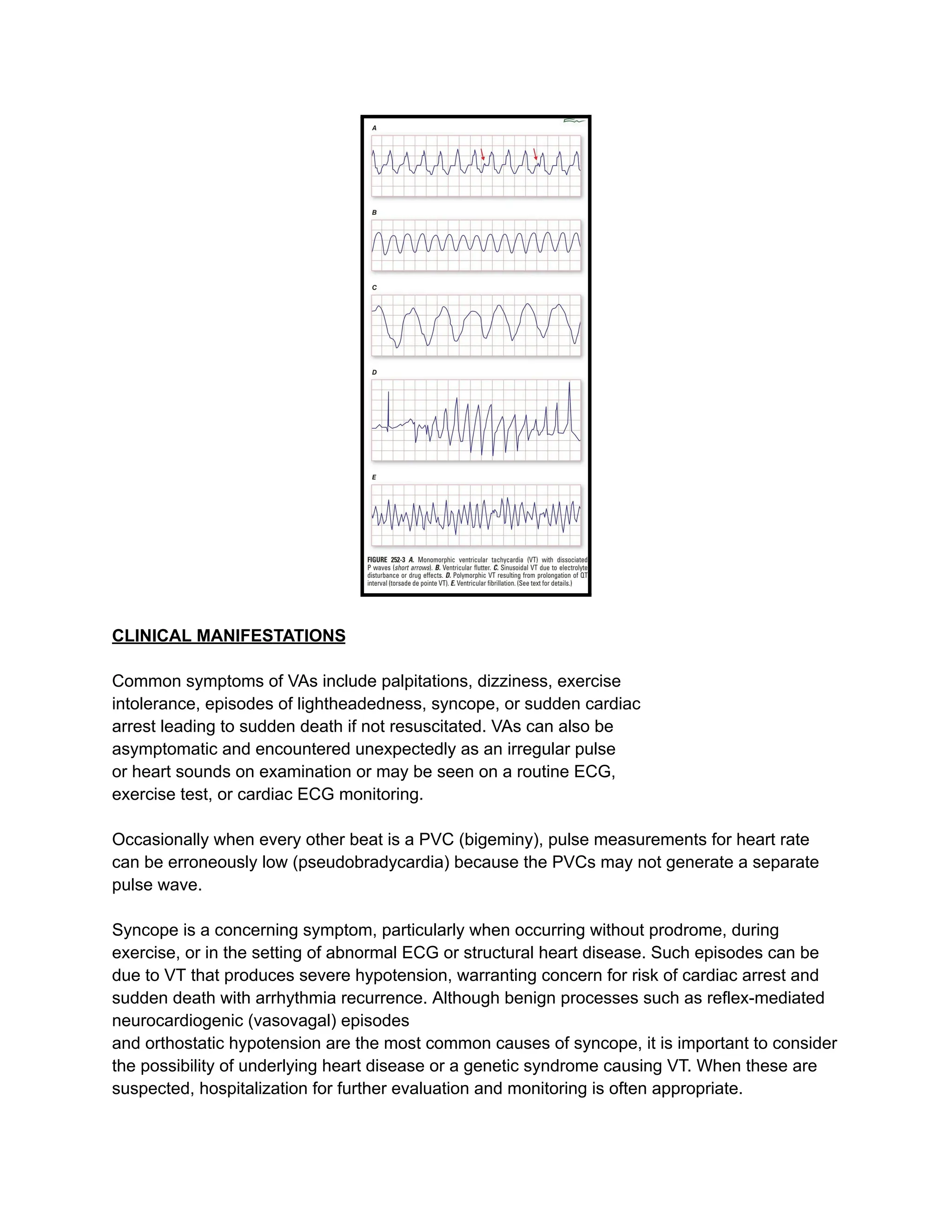 VENTRICULAR ARRHYTHMIAS ( VAs ) - Classification & Clinical Features .pdf