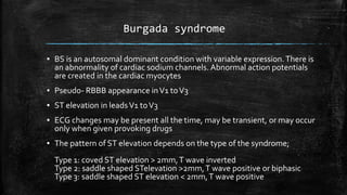 Ventricular arryhythmias | PPTX