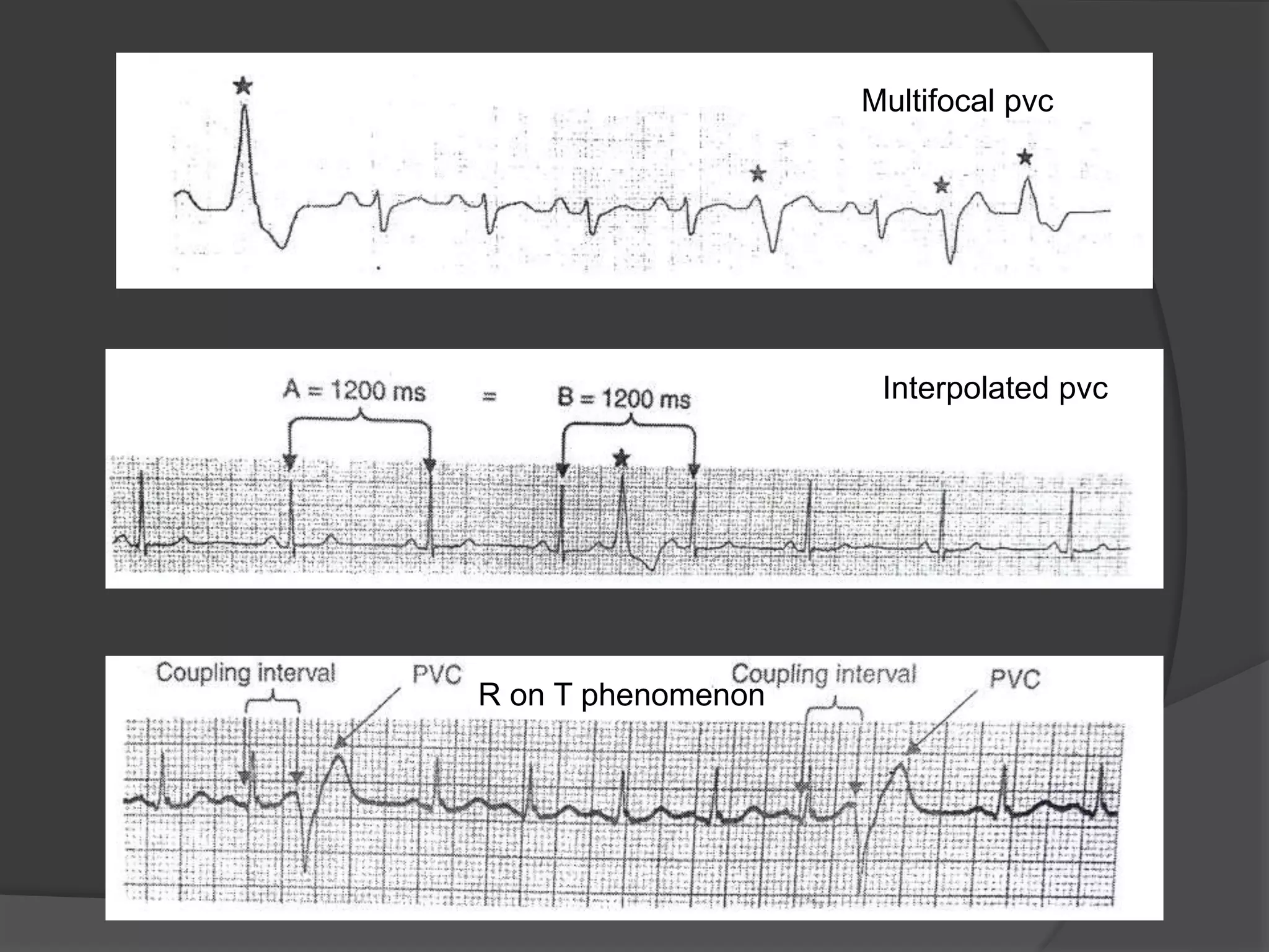 Ventricular arrythmia | PPTX