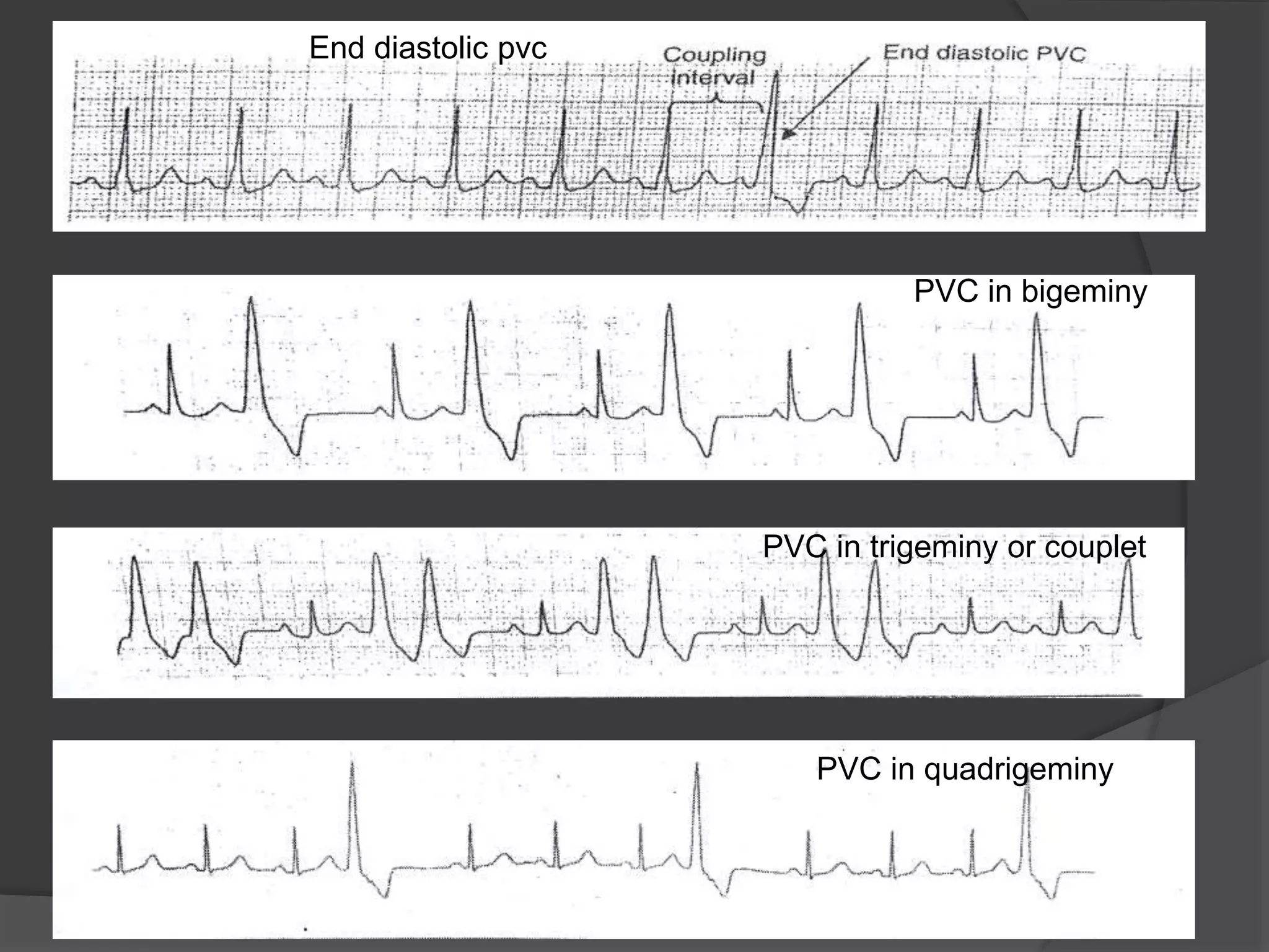 Ventricular arrythmia | PPTX