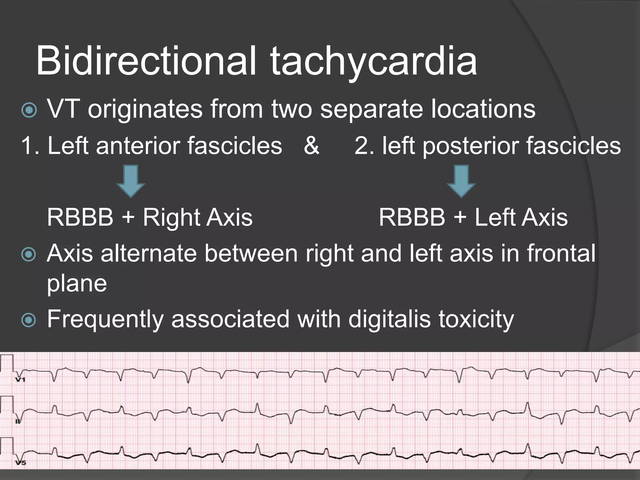 Ventricular arrythmia | PPTX