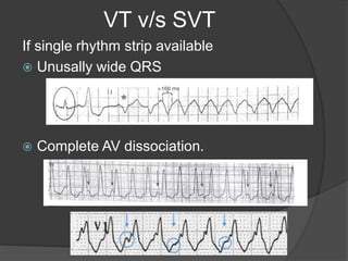 Ventricular arrythmia | PPTX