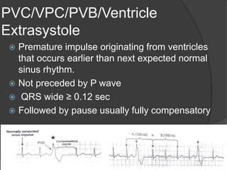 Ventricular arrythmia | PPTX