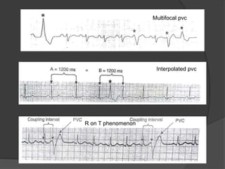 Ventricular arrythmia | PPTX
