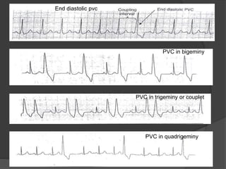 Ventricular arrythmia | PPTX
