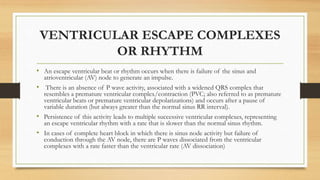 Ventricular arrythmia | PPTX
