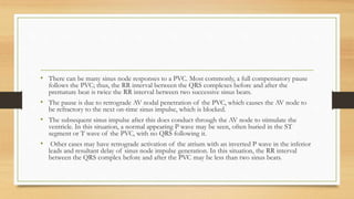 Ventricular arrythmia | PPTX