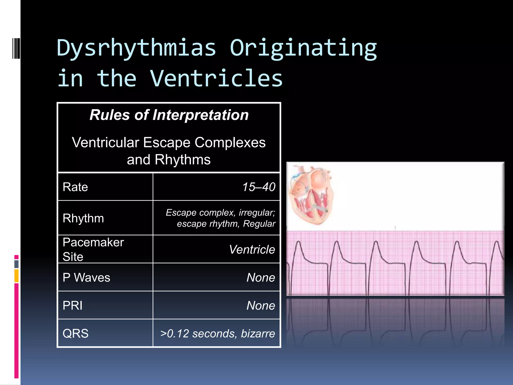 Ventricular dysrhythmias | PPTX