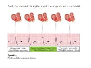 VENTRICULAR DYSRHYTHMIAS AND HOW TO INTERPRET IN ECG? | PPT