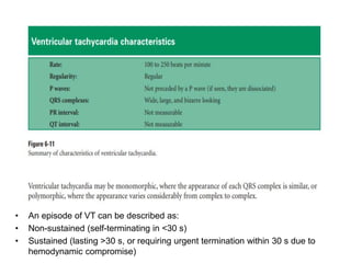 VENTRICULAR DYSRHYTHMIAS AND HOW TO INTERPRET IN ECG? | PPT