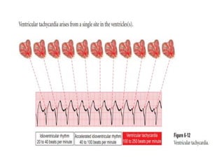 VENTRICULAR DYSRHYTHMIAS AND HOW TO INTERPRET IN ECG? | PPT