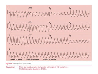 VENTRICULAR DYSRHYTHMIAS AND HOW TO INTERPRET IN ECG? | PPT