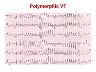 VENTRICULAR DYSRHYTHMIAS AND HOW TO INTERPRET IN ECG? | PPT