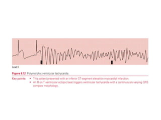 VENTRICULAR DYSRHYTHMIAS AND HOW TO INTERPRET IN ECG? | PPT