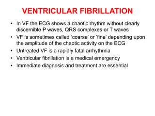 VENTRICULAR DYSRHYTHMIAS AND HOW TO INTERPRET IN ECG? | PPTX