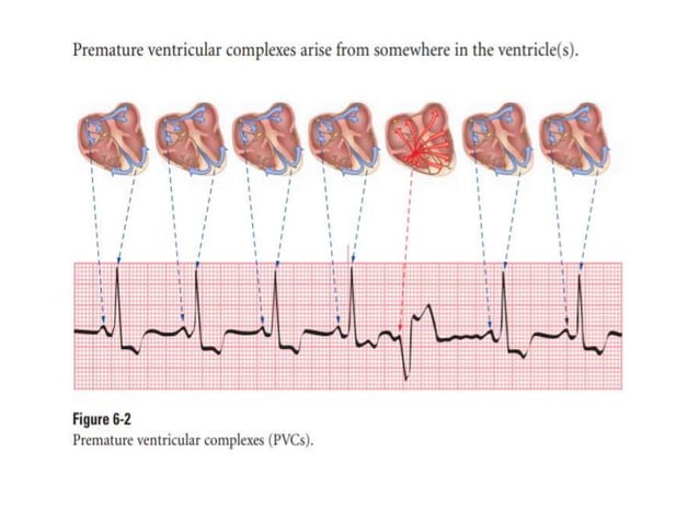 VENTRICULAR DYSRHYTHMIAS AND HOW TO INTERPRET IN ECG? | PPT