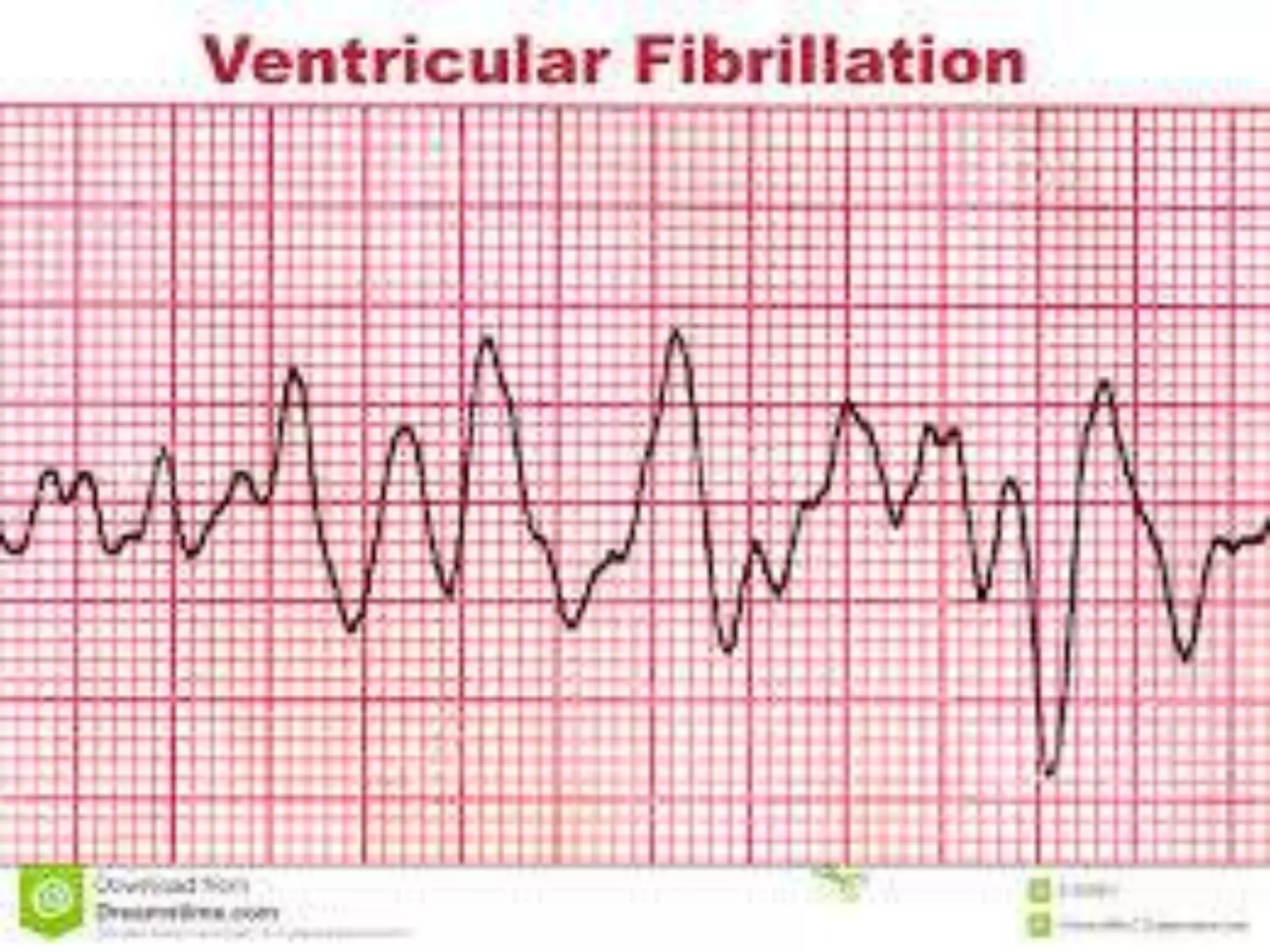 Ventricular fibrillation | PPTX