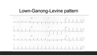 Ventricular preexcitation syndrome.pptx