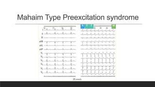 Ventricular preexcitation syndrome.pptx