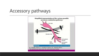 Ventricular preexcitation syndrome.pptx