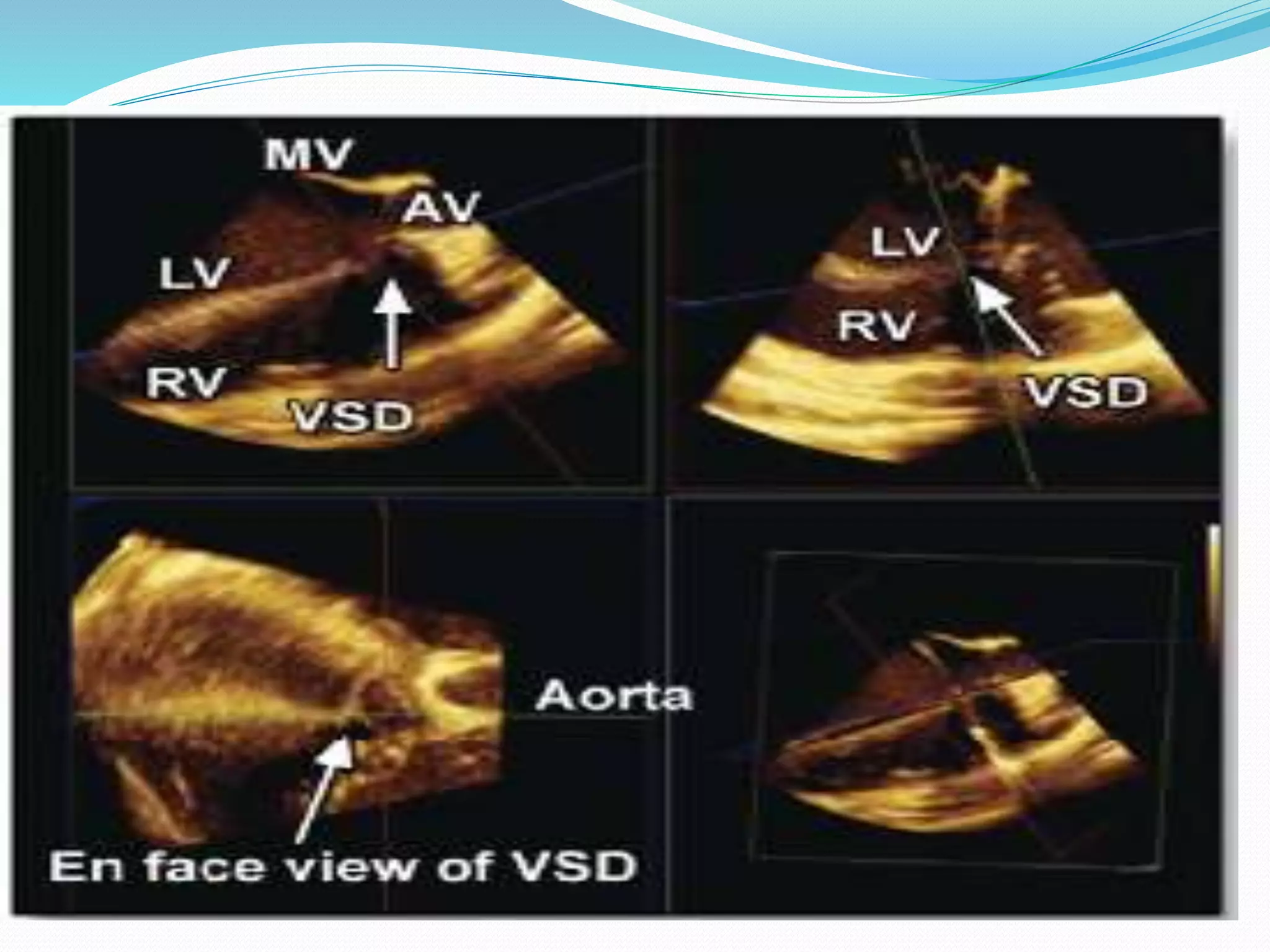 Ventricular septal defect | PPTX