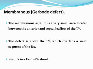 Ventricular septal defect | PPTX