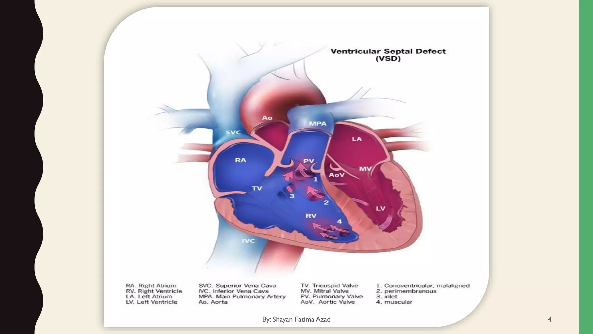 Ventricular septal defect | PDF