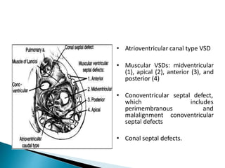 Ventricular septal defect | PPTX