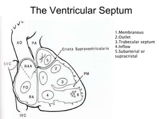 Ventricular septal defect | PPTX
