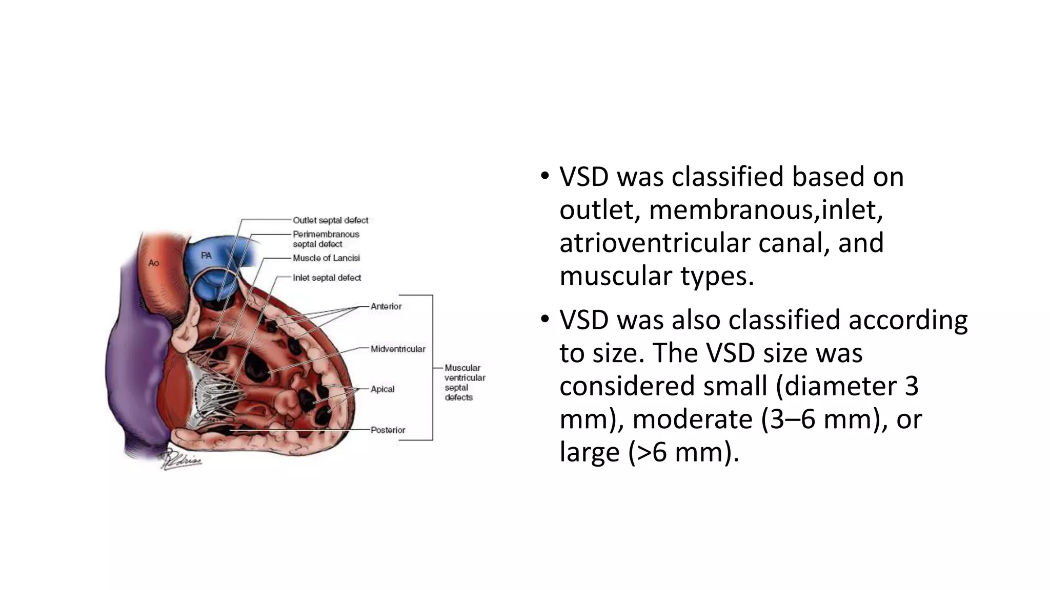 Ventricular septal defect | PPTX