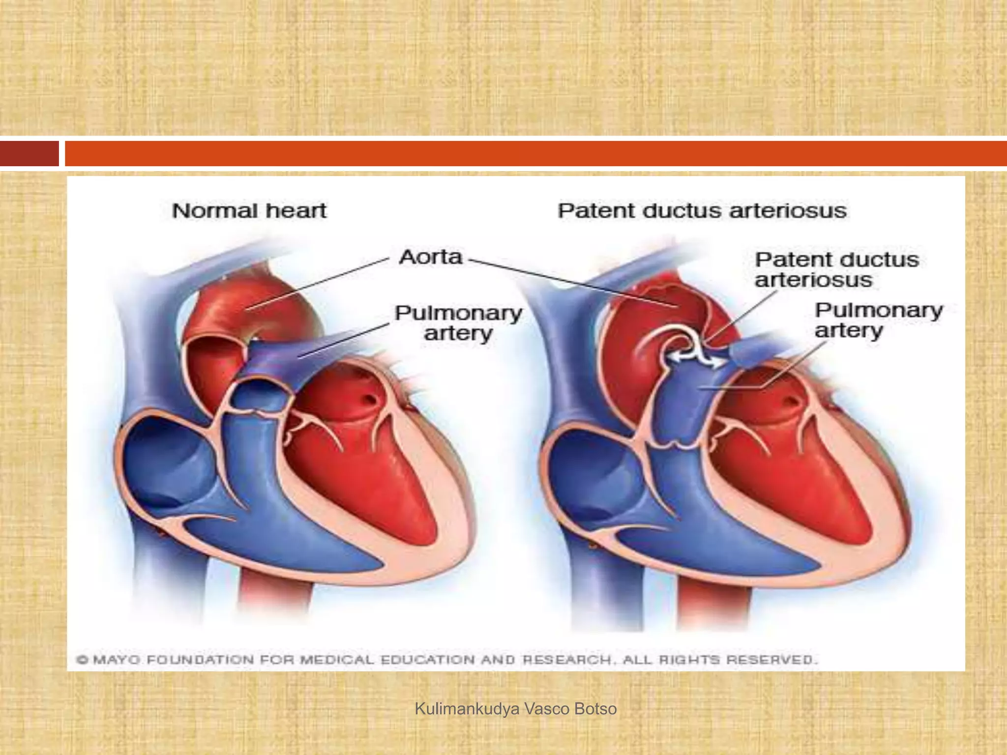VENTRICULAR SEPTAL DEFECT.ppt