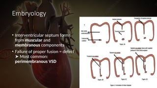 Ventricular septal defect.pptx.......... | PPTX