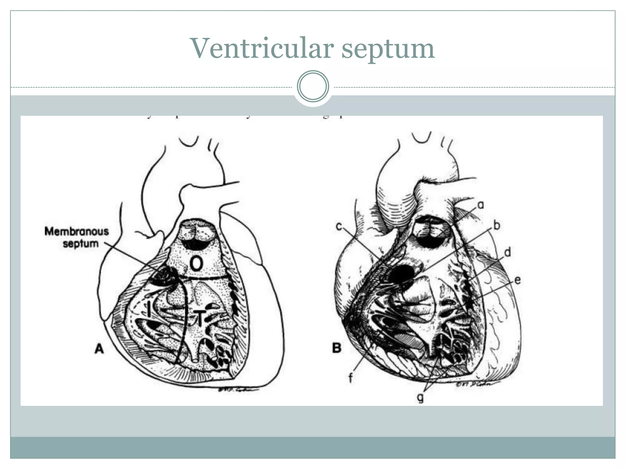 Ventricular septal defects | PPTX