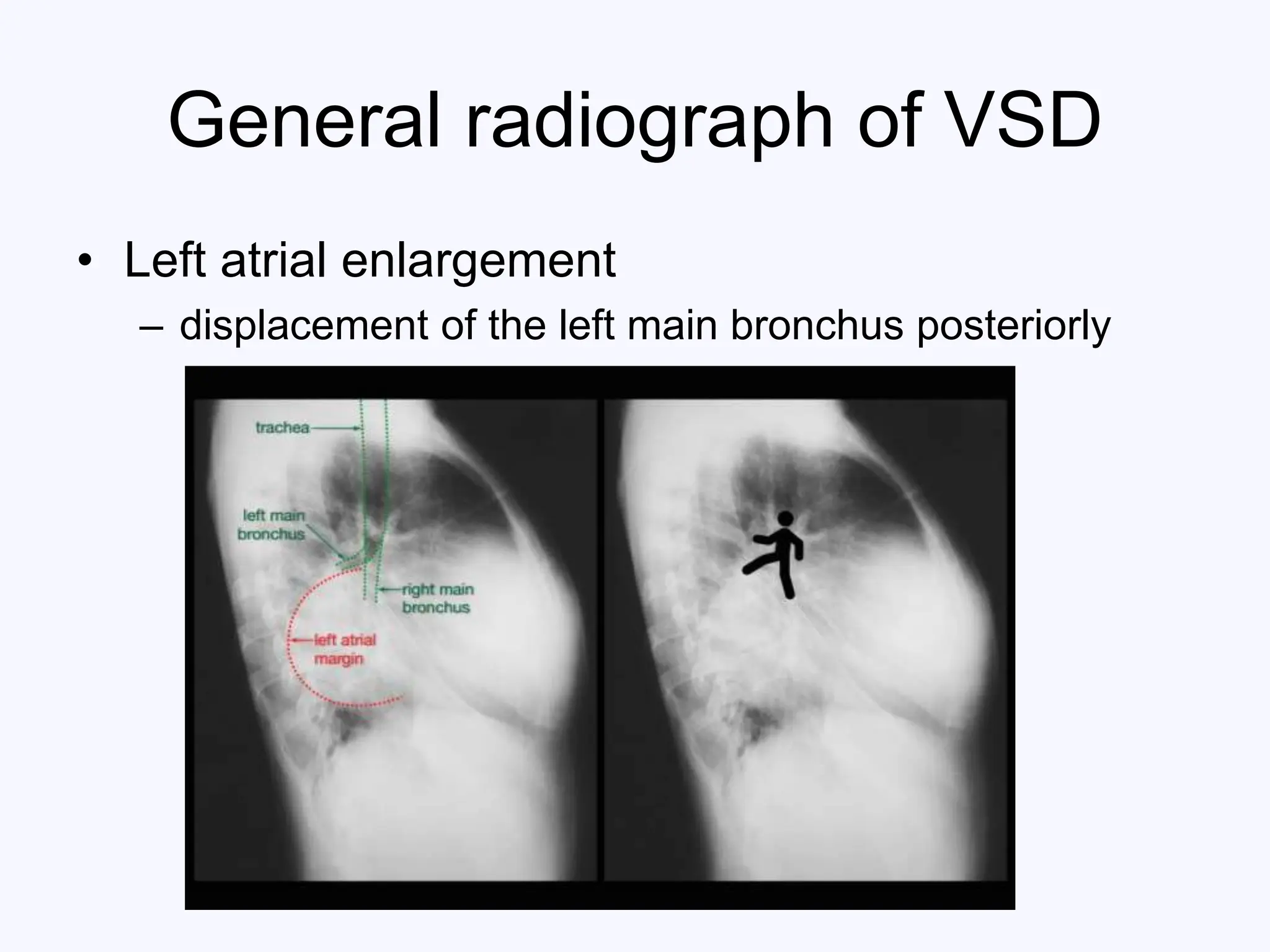 Imaging of Ventricular Septal Defects.ppt