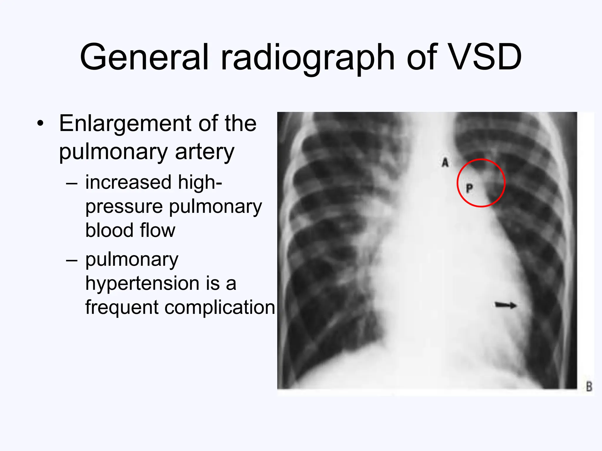 Imaging of Ventricular Septal Defects.ppt