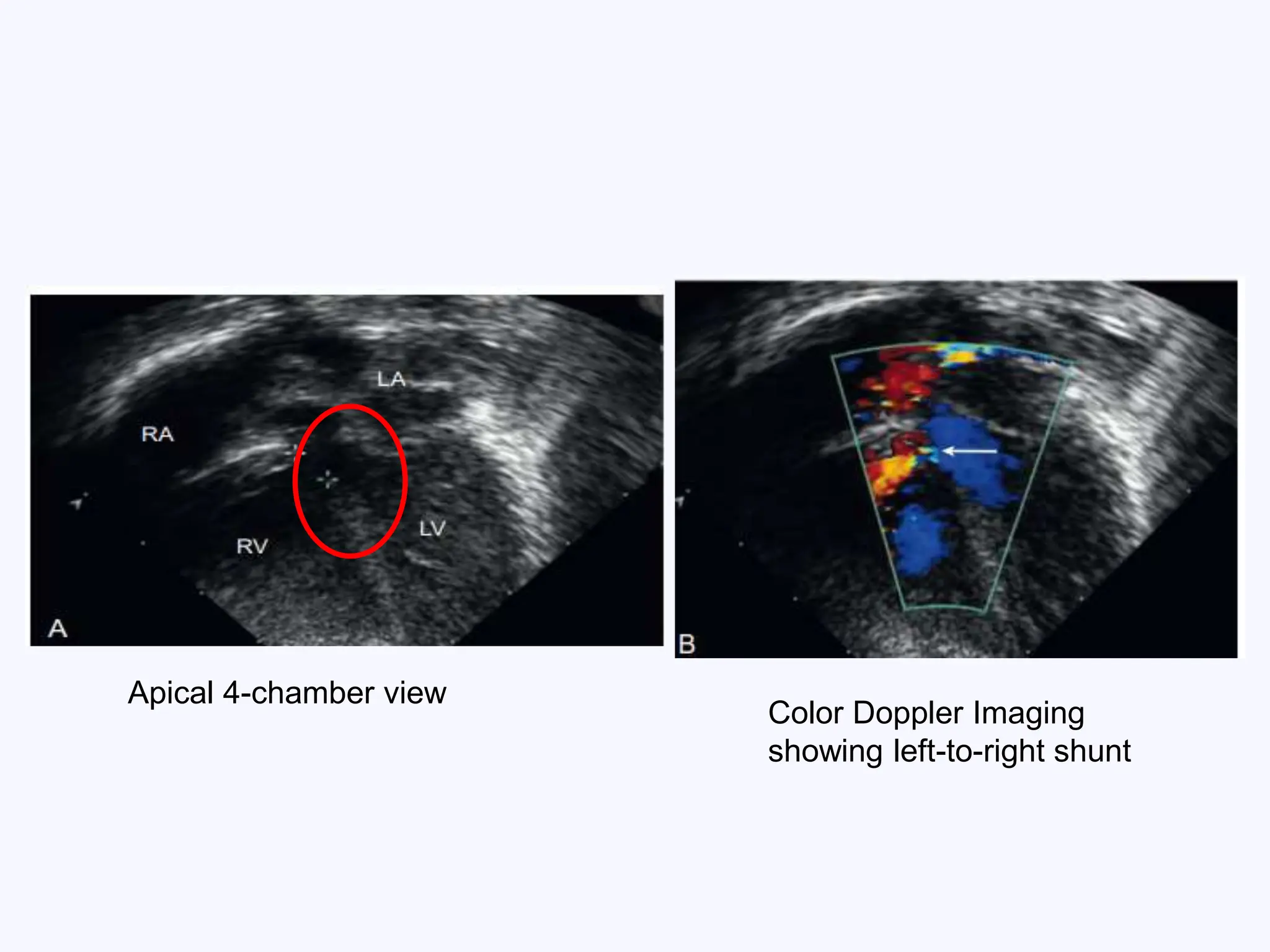 Imaging of Ventricular Septal Defects.ppt