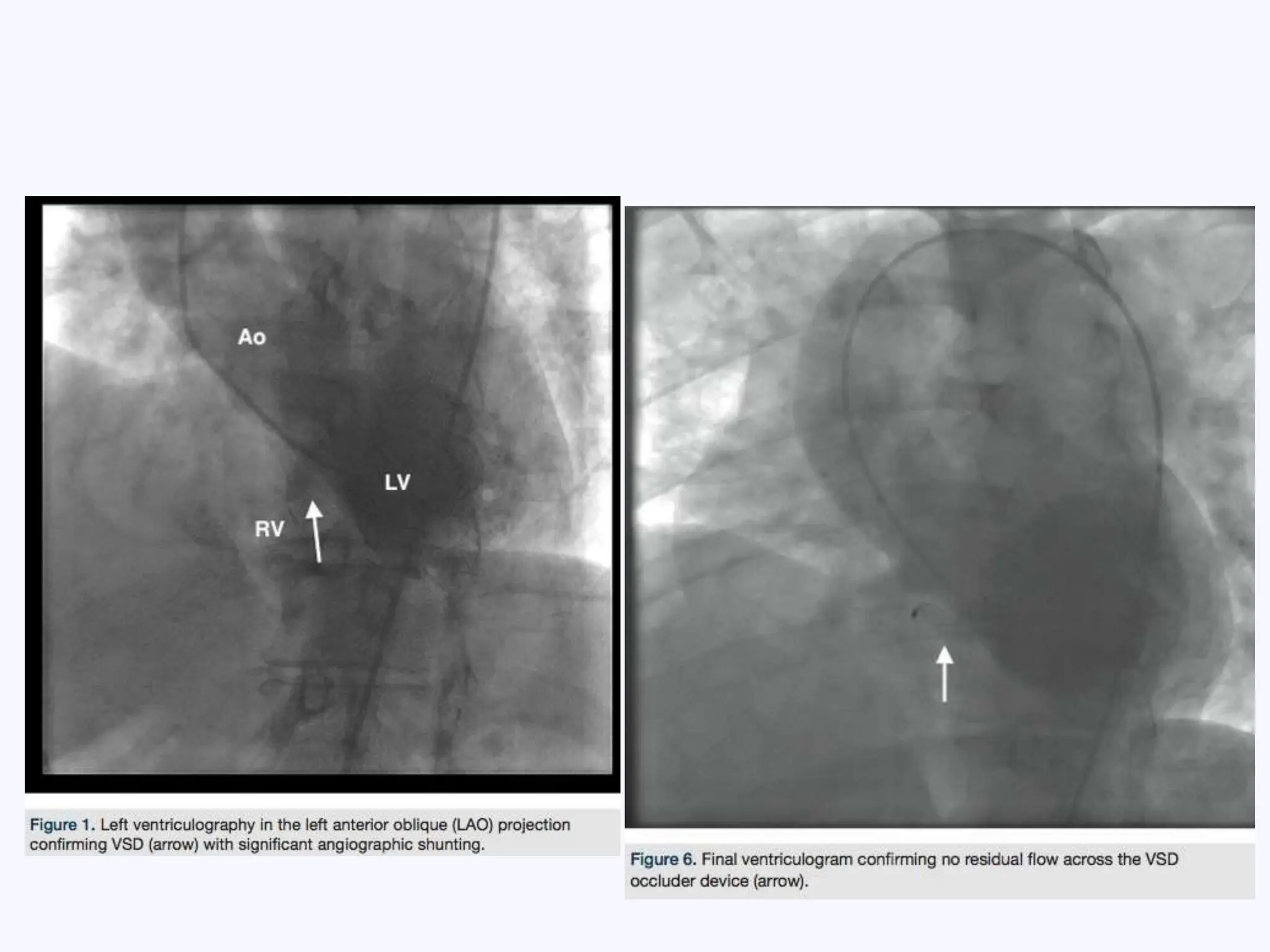 Imaging of Ventricular Septal Defects.ppt