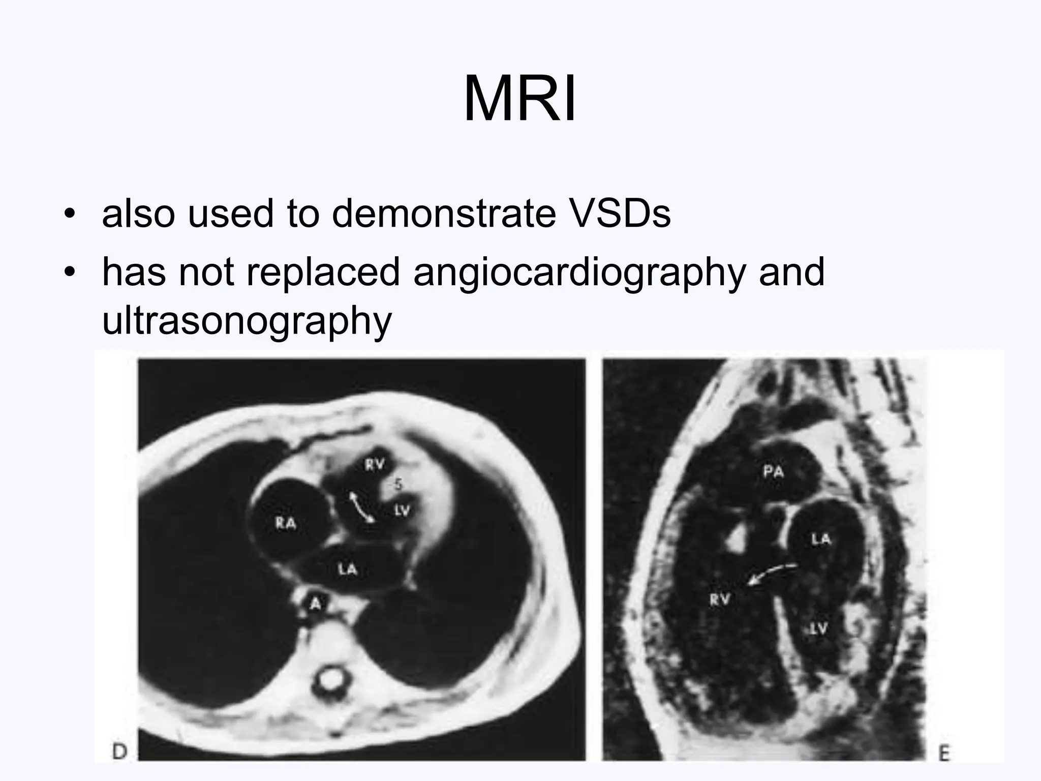 Imaging of Ventricular Septal Defects.ppt