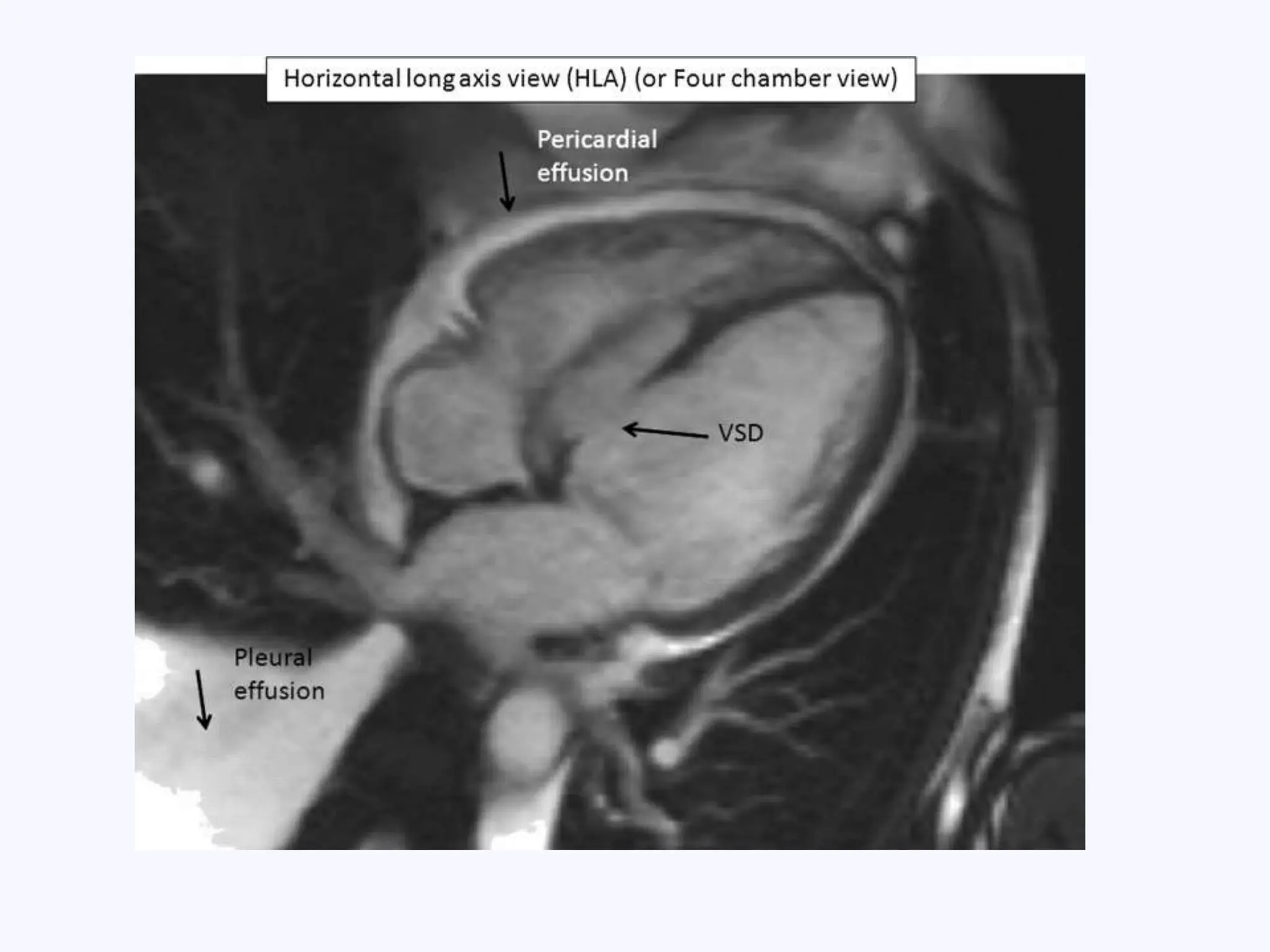 Imaging of Ventricular Septal Defects.ppt