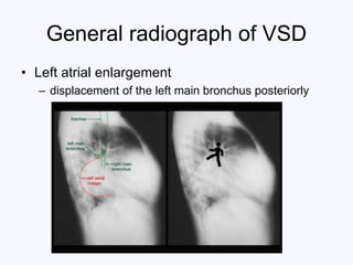 Imaging of Ventricular Septal Defects.ppt