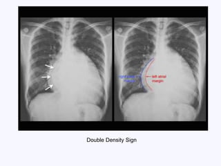Imaging of Ventricular Septal Defects.ppt
