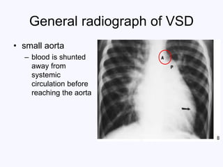 Imaging of Ventricular Septal Defects.ppt