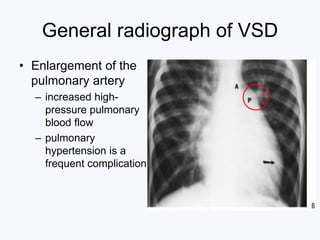 Imaging of Ventricular Septal Defects.ppt
