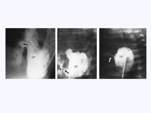 Imaging of Ventricular Septal Defects.ppt