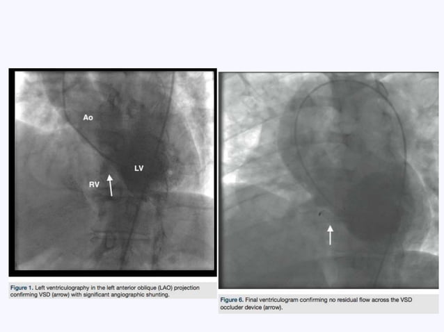 Imaging of Ventricular Septal Defects.ppt