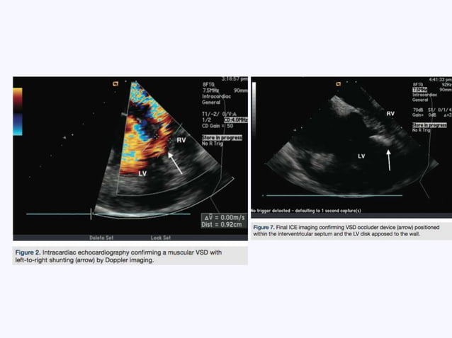 Imaging of Ventricular Septal Defects.ppt
